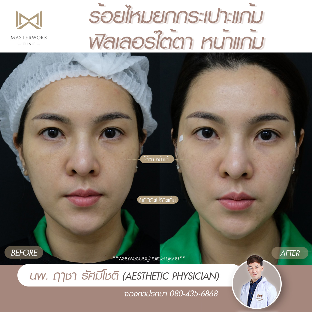 ร้อยไหม MINT ยกกระชับ - Masterwork Clinic