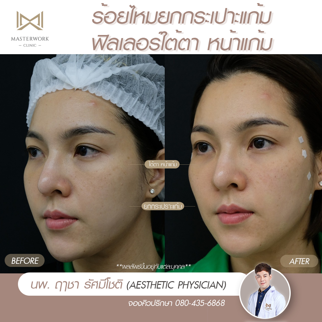 ร้อยไหม MINT ยกกระชับ - Masterwork Clinic