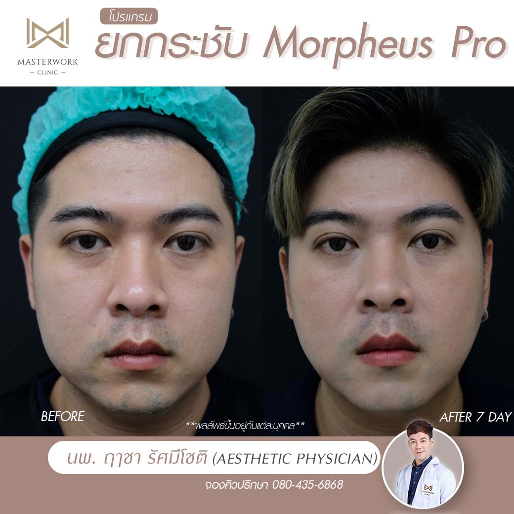 Morpheus Pro ยกกระชับผิว - Masterwork Clinic